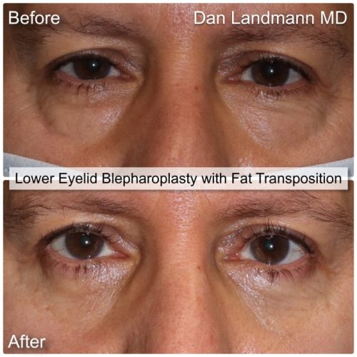 Eye Bag Surgery / Lower Lid Blepharoplasty in River Edge, NJ
