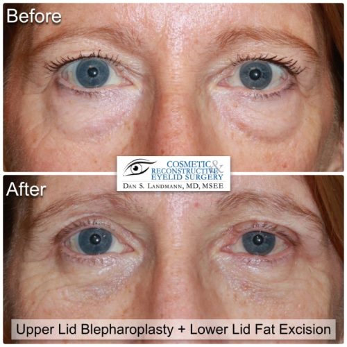 Eye Bag Surgery / Lower Lid Blepharoplasty in River Edge, NJ